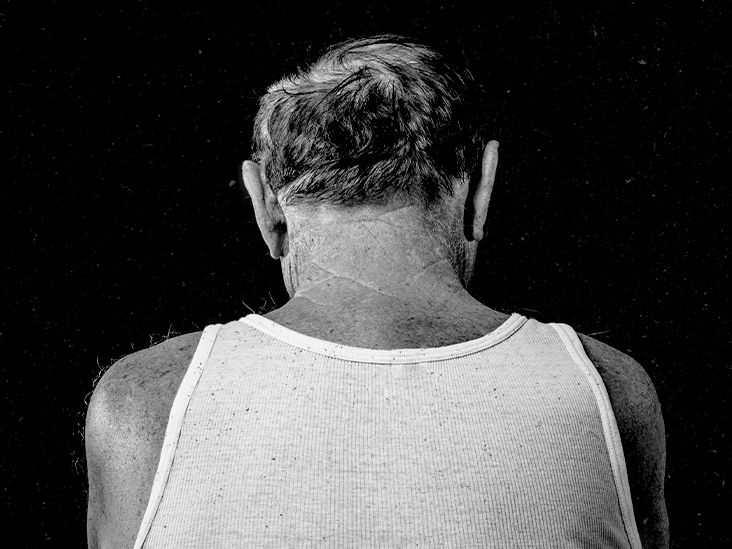 Seizure after stroke: Symptoms, treatment, and more
