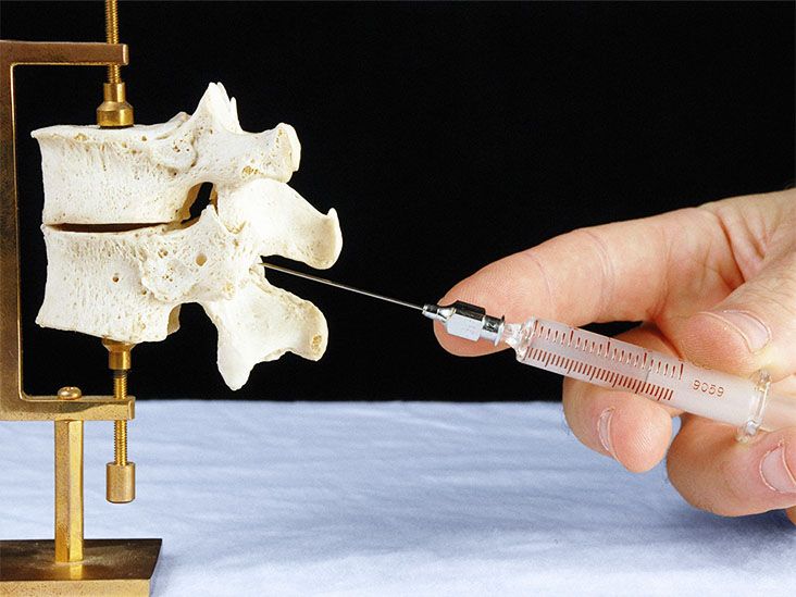 Epidural steroid injection: Benefits, risks, results, and more