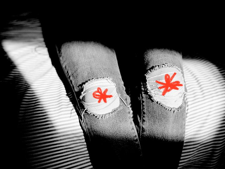 Plica syndrome: Symptoms, diagnosis, and more