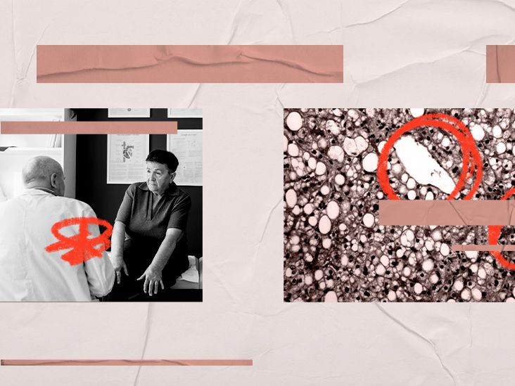 Steatosis: Definition, symptoms, treatment, and more