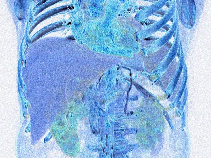 Recommended Algorithm For Treatment Of Acute Portal Vein Thrombosis