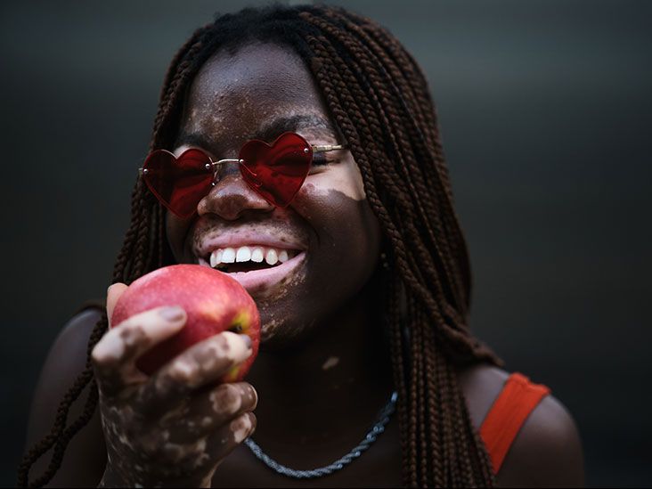 What to eat if you have vitiligo