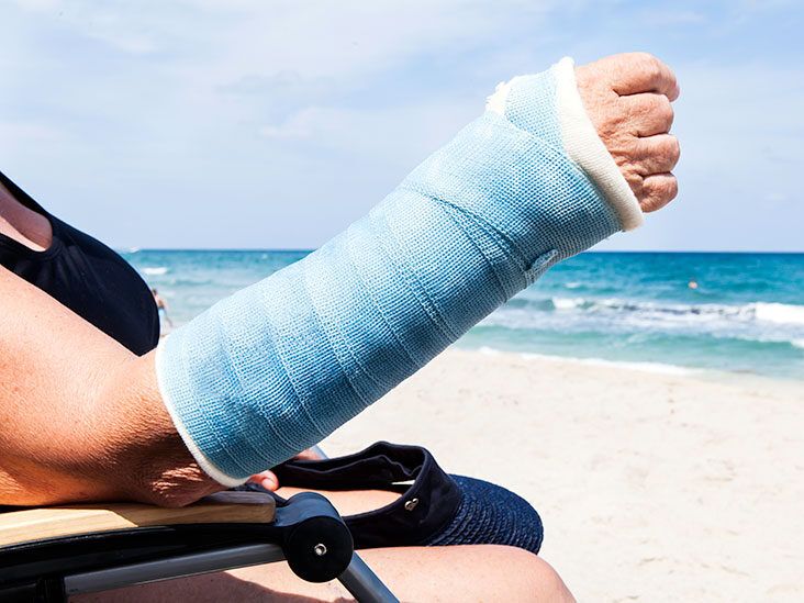 Scaphoid Bone Cast
