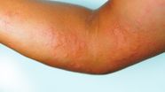 Itchy Skin Hives Itchy Skin Hives