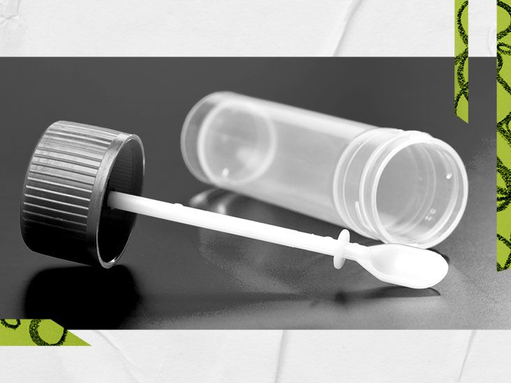 Ulcerative colitis: Could mucus changes in stool aid early diagnosis?