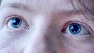 Eye Swelling After Head Injury Infoupdate Eye Swelling After Head Injury Infoupdate