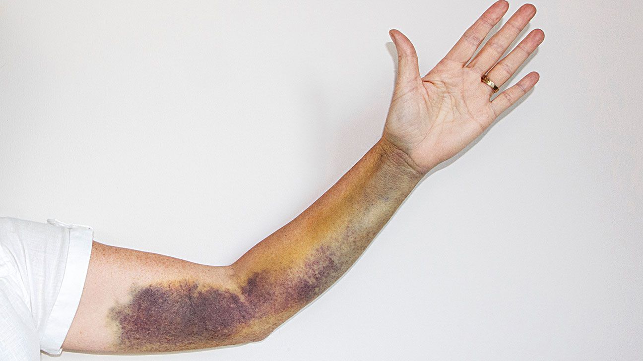 Why Is My Hand Still Swollen After Elbow Surgery - Infoupdate.org