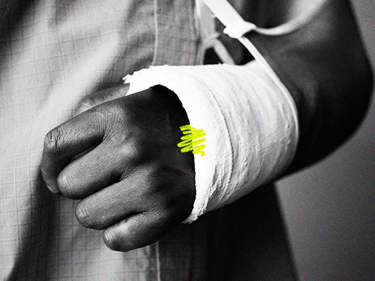 Closed reduction fracture: What to expect, recovery, and benefits