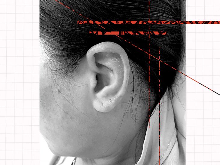 Relapsing polychondritis: What are early symptoms?