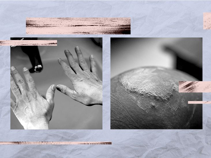 Eczema: Common areas and more