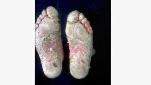 Pies Con Psoriasis Leve 8732