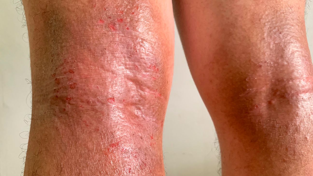 Eczema On Knees