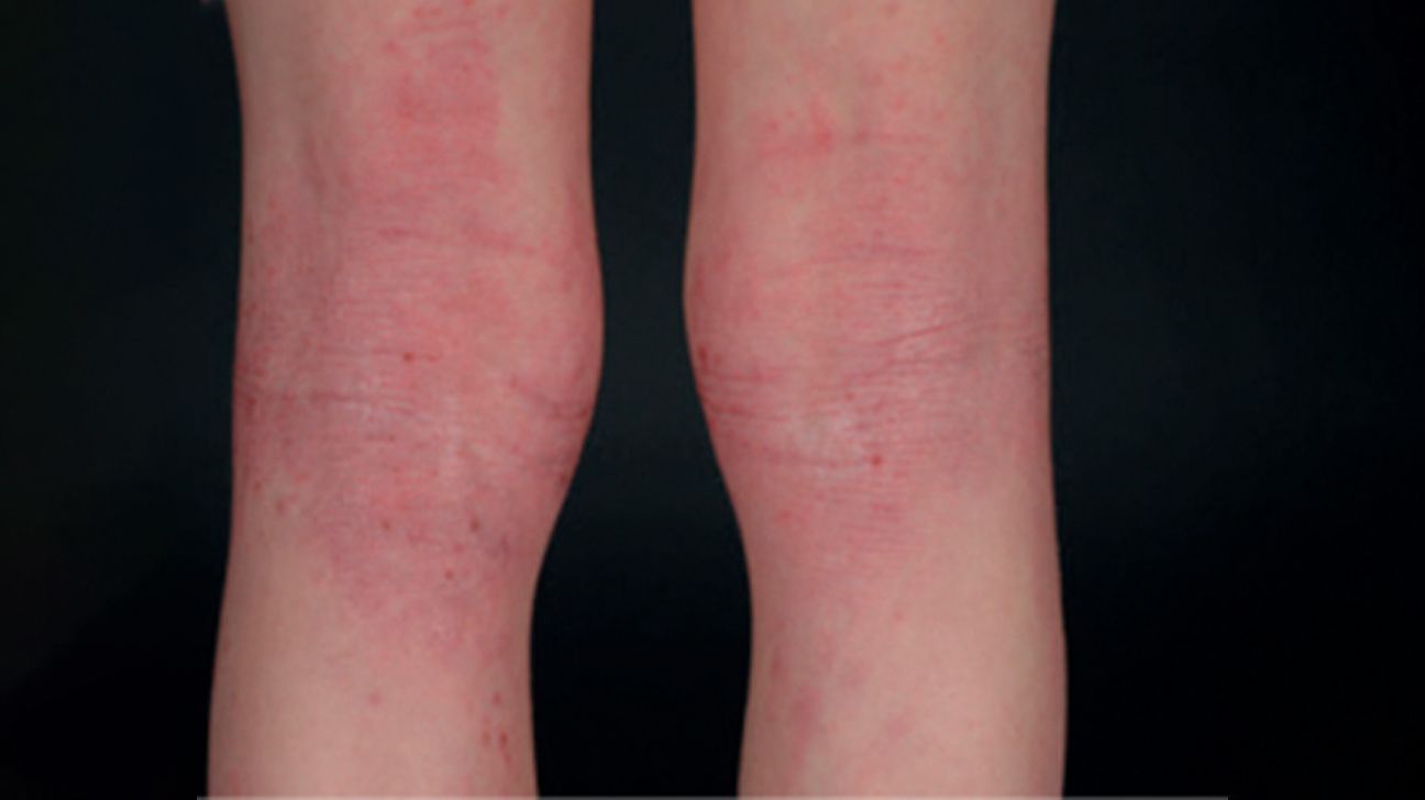 Eczema Behind Knees And On Legs 7 Year Old With Eczema Itchy Rash