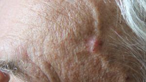 supratrochlear vein forehead