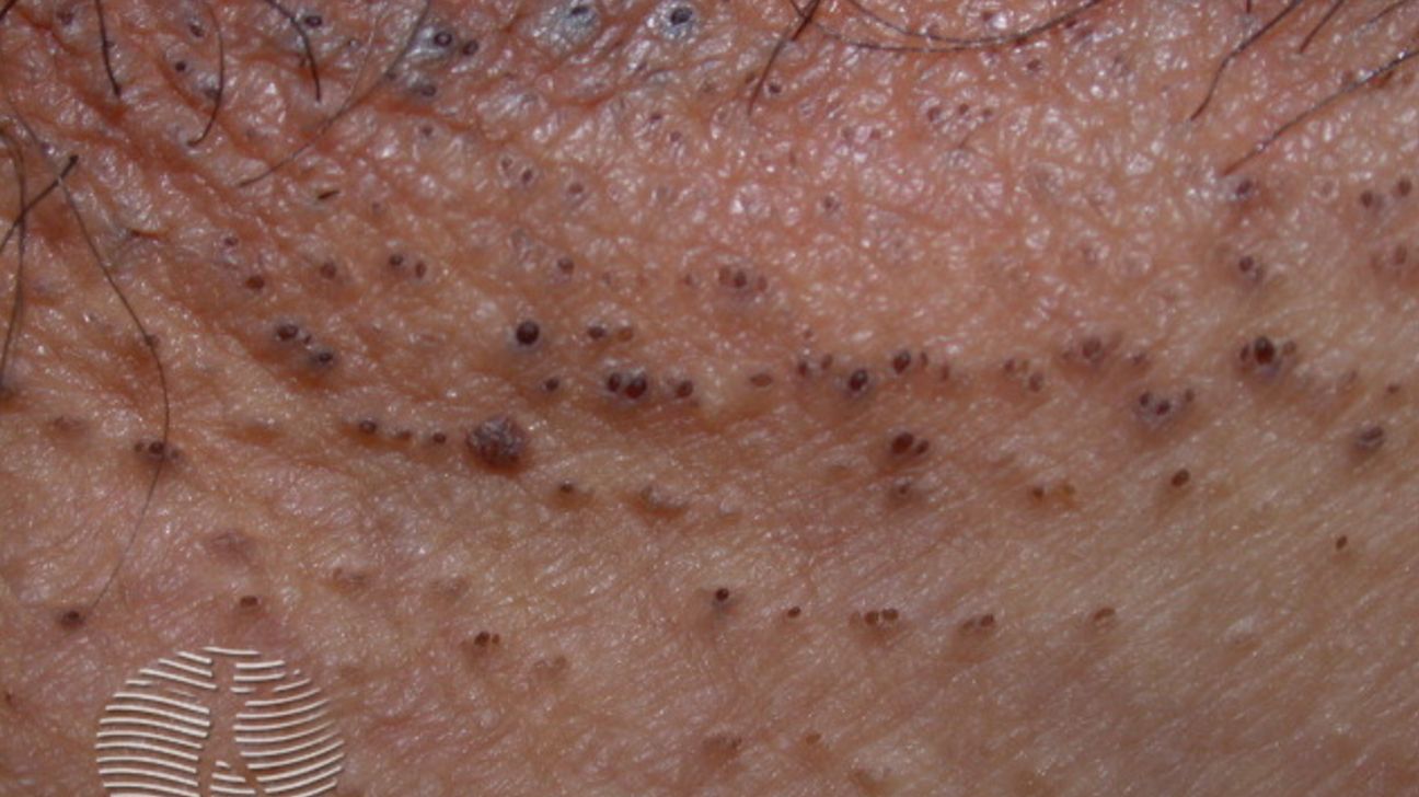 Hidradenitis Suppurativa Face Hidradenitis Suppurativa Almostadoctor