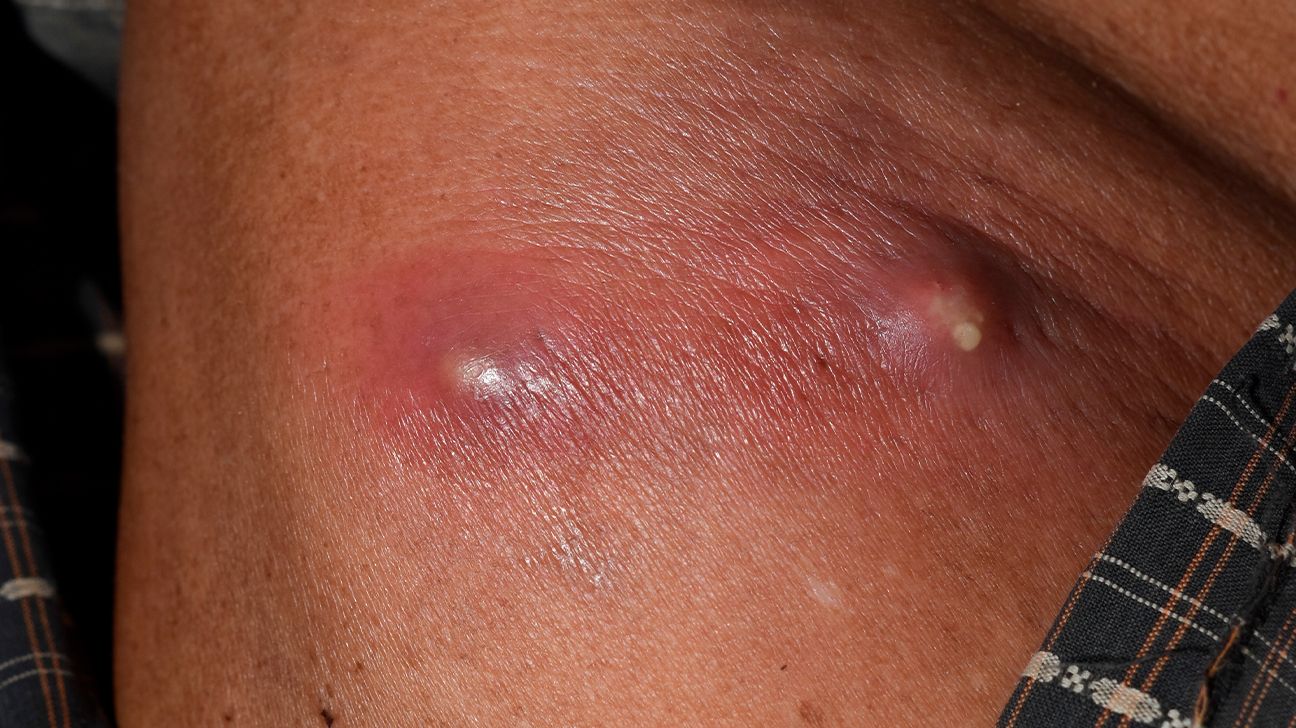 Hidradenitis Suppurativa Groin Hidradenitis Suppurativa The Skin