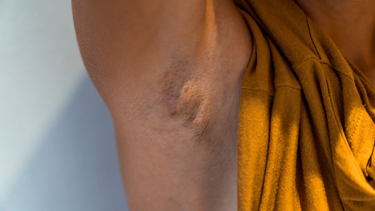 Hidradenitis Suppurativa Stage 1 🚨 Stages Of Hidradenitis