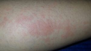 Skin Rashes On Legs
