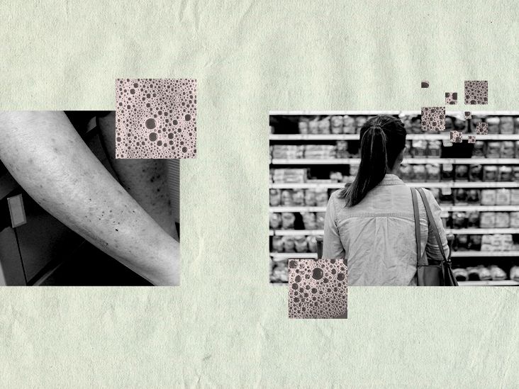 Celiac Rash What It Looks Like Symptoms And Triggers