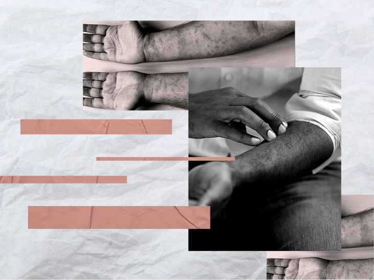 Contact dermatitis rash: Pictures, treatment, and more