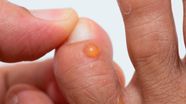 Itchy Blisters On Sole Of Foot Outlet Emergencydentistry Itchy Blisters On Sole Of Foot Outlet Emergencydentistry
