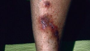 Eczema On Shins