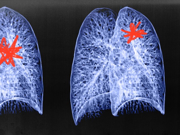 Lung cancer: AI tool Sybil may be able to predict risk within 6 years
