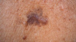Pre Cancer Skin Spots