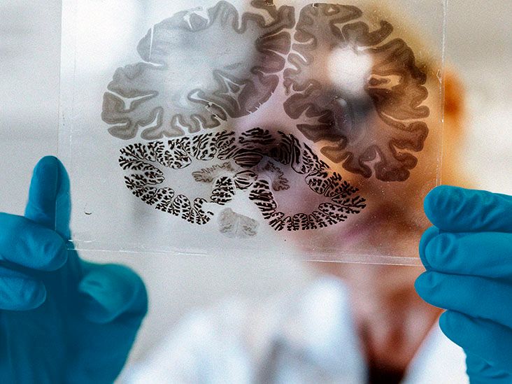 PLS vs. ALS: Symptoms, causes, and treatments