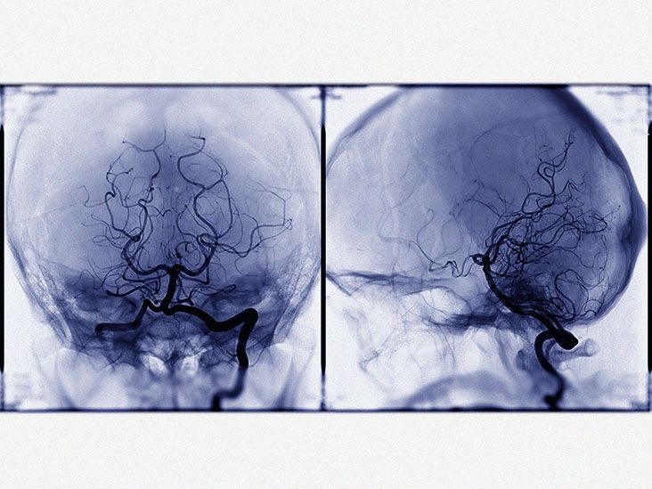 What can cause a brain aneurysm to rupture?