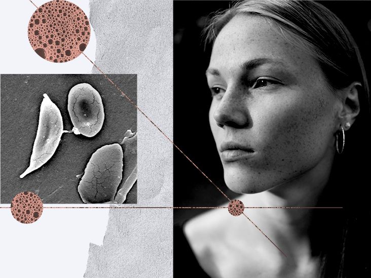 Sickle cell disease and disability