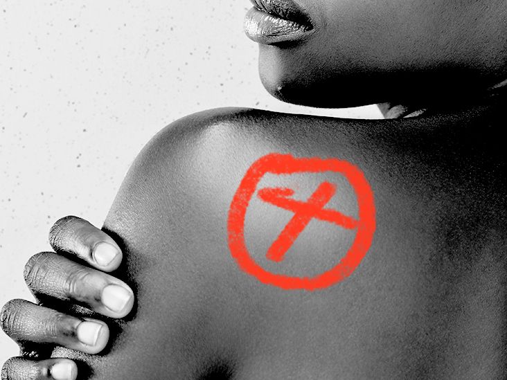 Causes of bullseye-shaped rash that are not Lyme disease