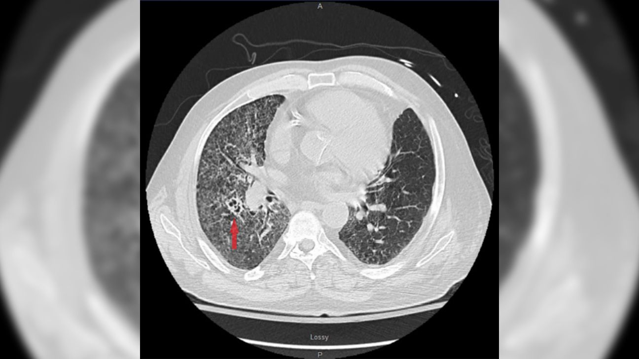 Histoplasmosis Lung X Ray