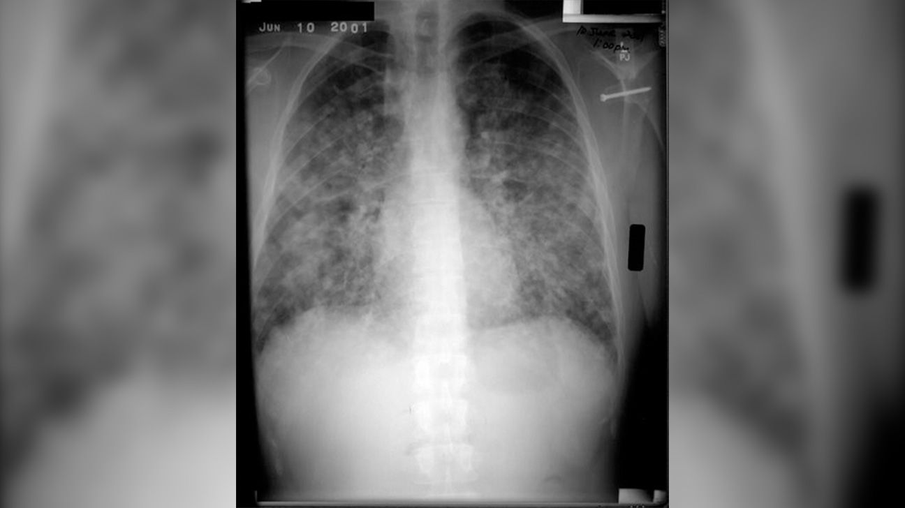 Histoplasmosis Lung X Ray