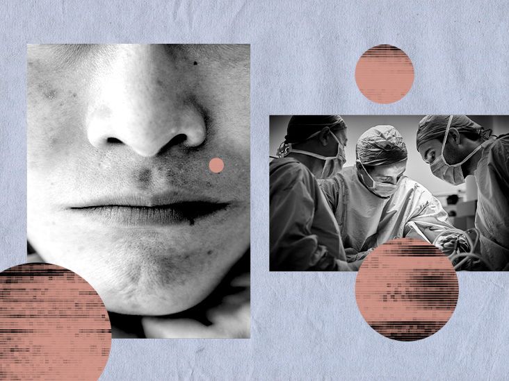 Plastic surgery for acne scars: Can they be helpful?