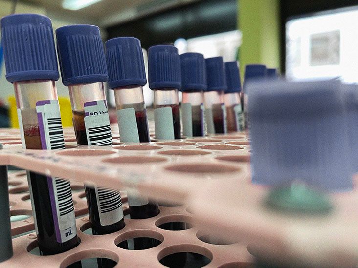 Anti-CCP for rheumatoid arthritis: Ranges and results