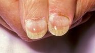 White Nails Health Causes Science And Long Term Nail Care Explained