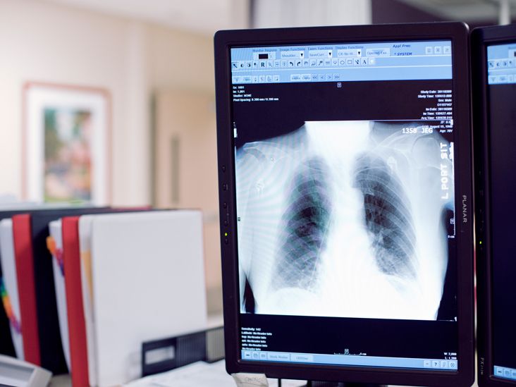 Pulmonary contusion: Symptoms, treatment, outlook, and more