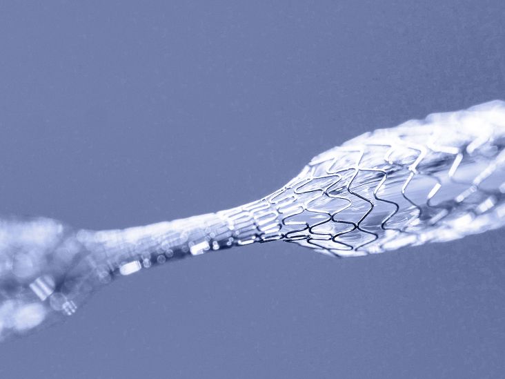 Stent placement for brain aneurysms