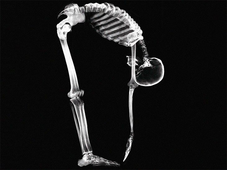 What is bone tuberculosis?