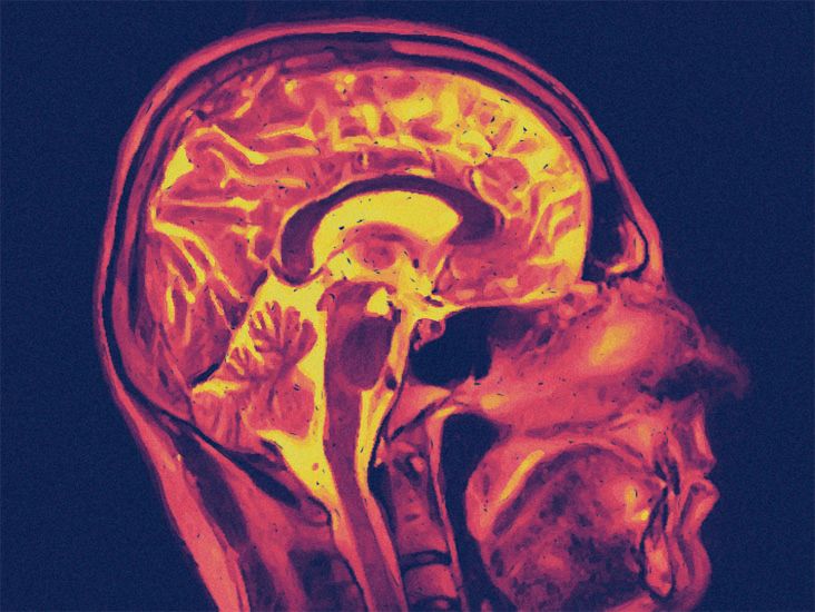 Radiation for brain cancer: Side effects and management