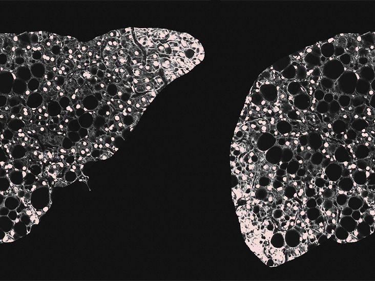 Is fatty liver dangerous? Stages, complications, risks, treatments