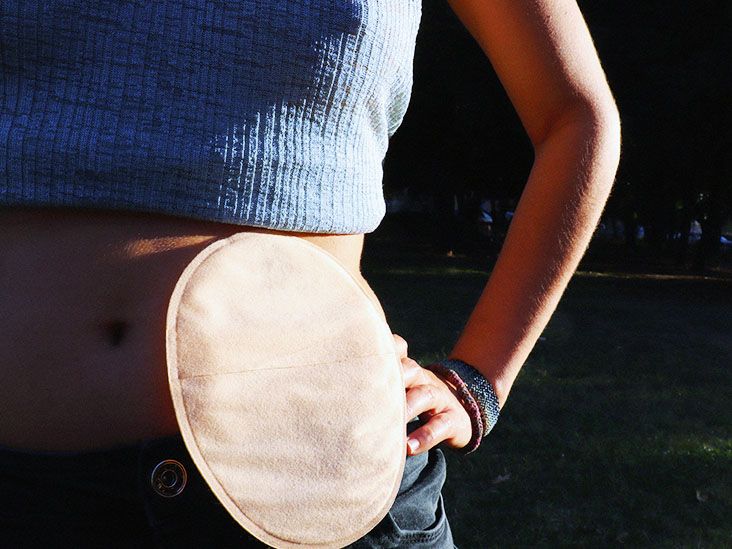 Loop colostomy: Uses and procedure