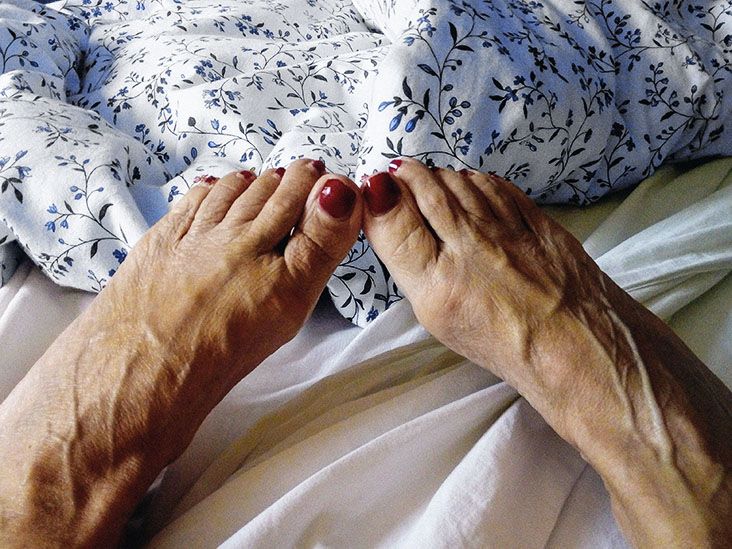 Neuropathic arthritis: Symptoms and treatment
