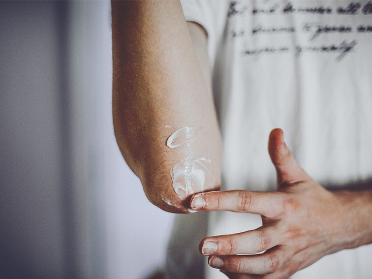 Psoriasis or ringworm? Symptoms, treatment, and other rashes