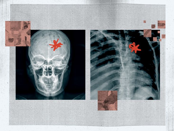 What Do Bone Lesions Look Like On X Ray