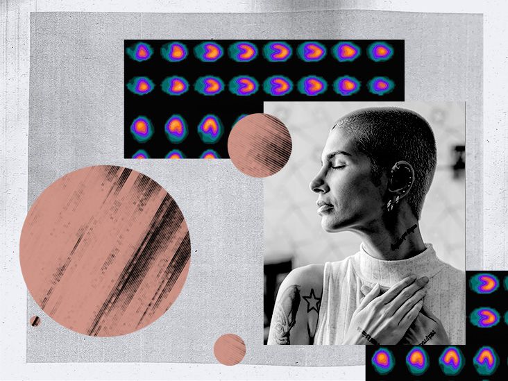 Heart perfusion imaging scan: Preparation, risks, and procedure