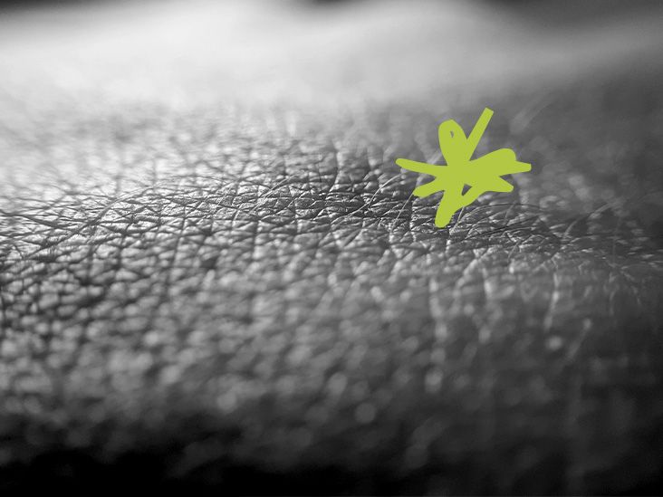 Eczema: How bacteria can accelerate the growth of skin condition