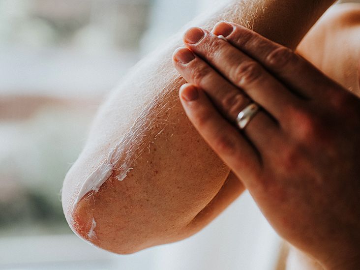 Shingles on arm: Symptoms, causes, treatments, and more