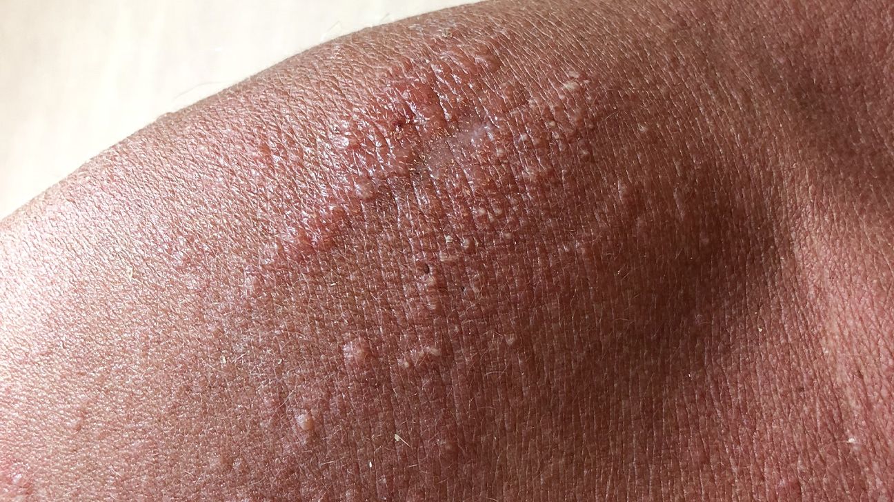 What Are The Little Black Dots On My Skin - Infoupdate.org
